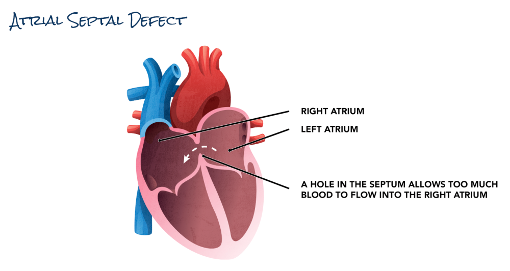 Atrial Septal Defect | SCAI - Seconds Count